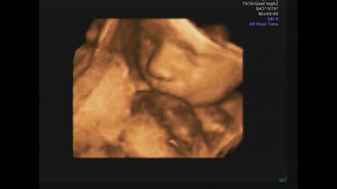 4d Ultrasound Beautiful Baby 30 Weeks Stock Footage Video (100% Royalty ...