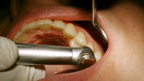 Dentist Drilling Cavities Molars Stock Footage Video (100% Royalty-free ...