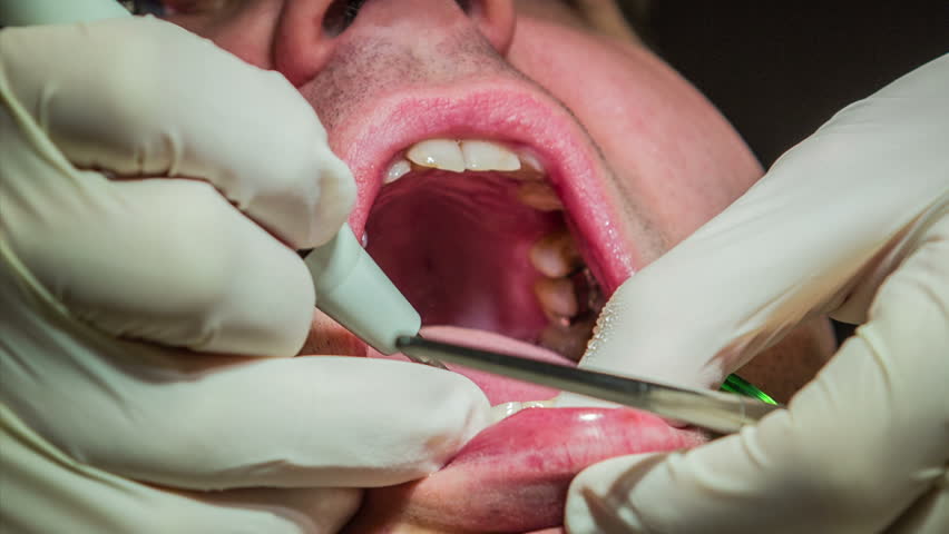 Dentist is Mending Patients Teeth Stock Footage Video (100% Royalty ...