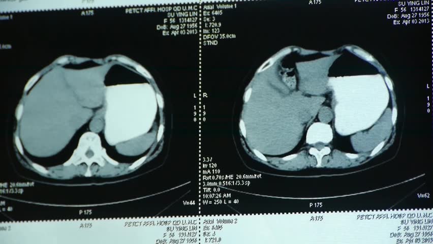 Doctor Study Gallbladder Pet-ct Scan,human Stock Footage Video (100% ...