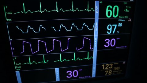 looped patient monitor displays vital signs Stock Footage Video (100% ...