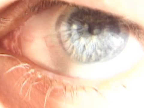 Close Conjunctival Calcification During Eye Examination Stock Photo ...