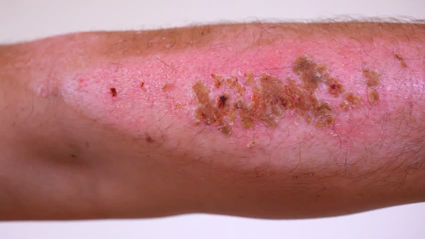 physical human injury wound medicine healthcare Stock Footage Video ...