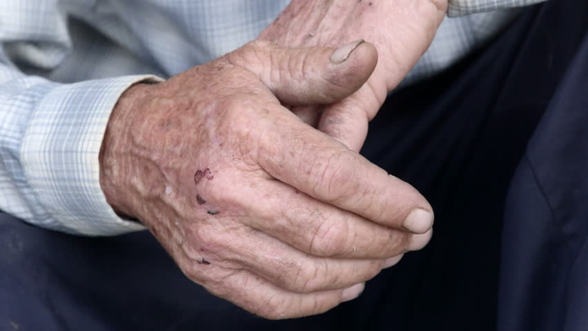 scraped overworked hands senior man Stock Footage Video (100% Royalty ...