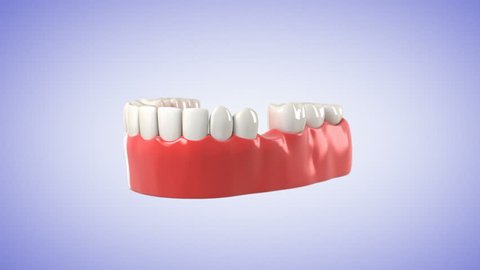 3 Unit Tooth Bridge High Quality Stock Footage Video (100% Royalty-free ...