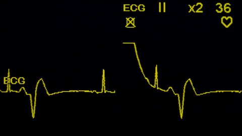 Ekg Monitor Displays Abnormal Heartbeat Pvcs Stock Footage Video (100% ...