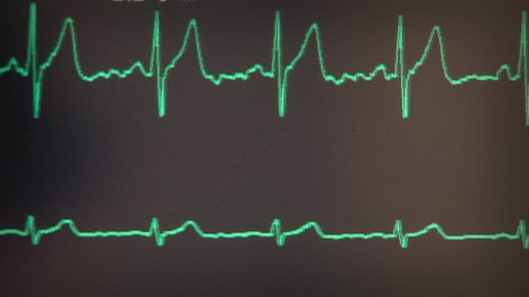 Heartbeat Stop Stock Footage Video (100% Royalty-free) 795418 ...