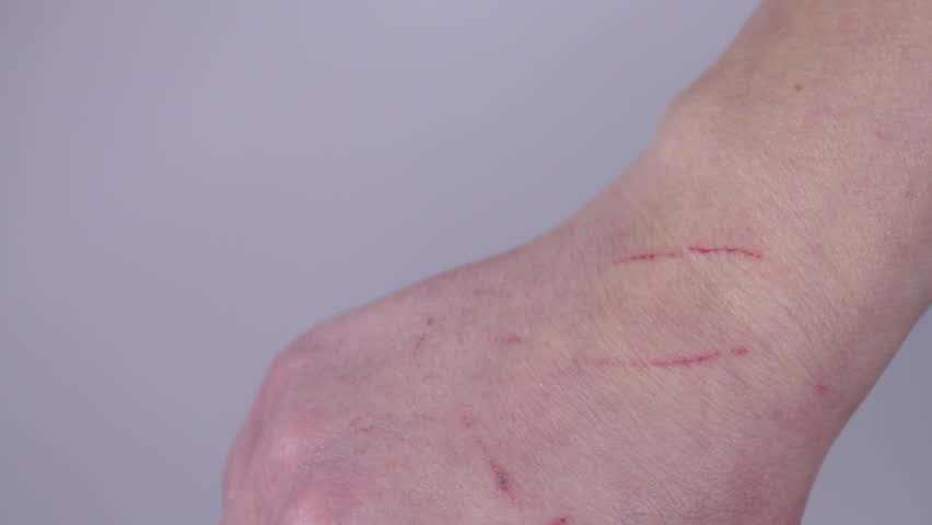 woman disinfects cat scratches on hand Stock Footage Video (100% ...