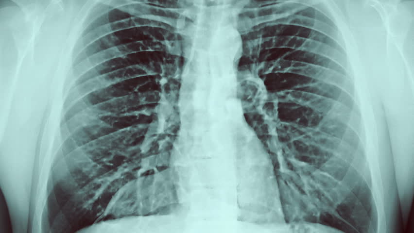 Chest X-ray and Gases. Animation 스톡 동영상 비디오(100% 로열티 프리) 9610991 ...