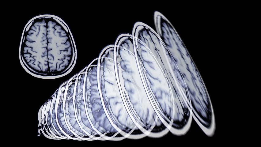 Brain Scan Slices Animation in Stock Footage Video (100% Royalty-free ...